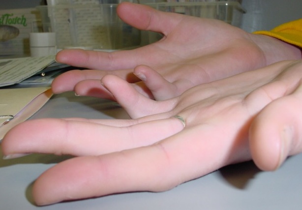 CAMPTODACTYLY | Hand Surgery Resource